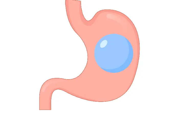 Artículo sobre el Balón intragástrico ofrecido por Dr. Manuel Meza Jasso